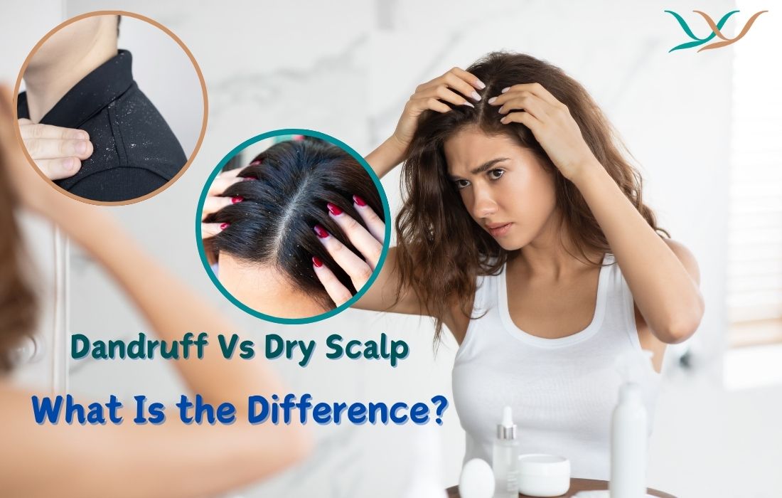Dandruff vs. Dry Scalp - YASHARTH